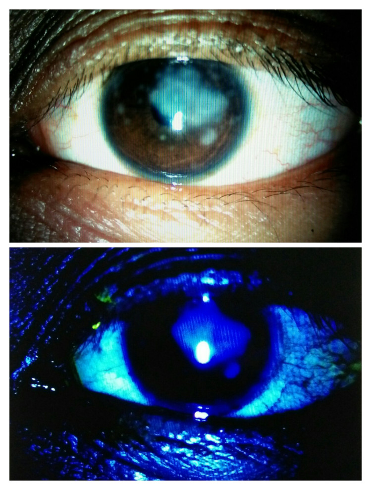 Erosi Kornea (H.18) – Belajar Sehat